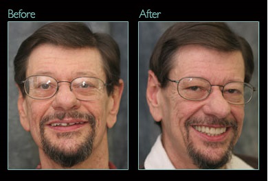 Dentures Herndon | Reston Partial Dentures | Virginia Dentistry by Design